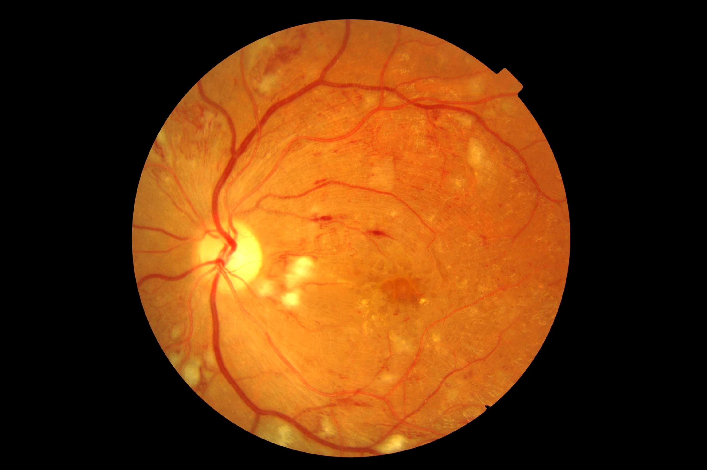Derbyshire Opticians Retinal Screening Derbyshire Opticians Retinal Screening